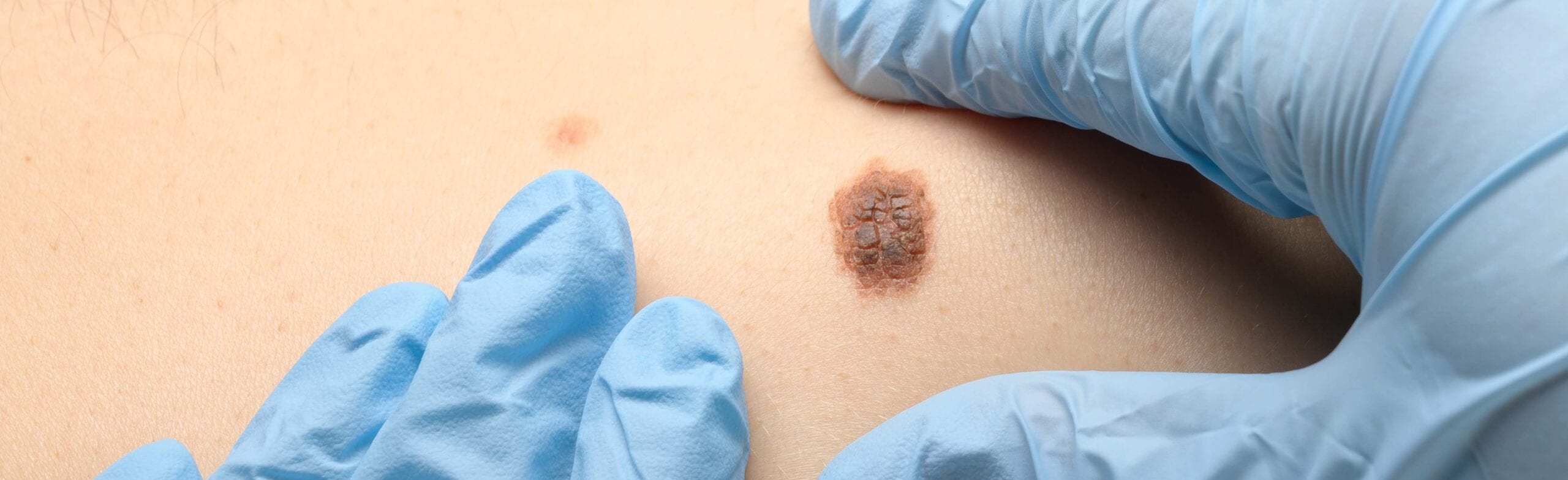 Mohs Surgery Recovery FAQs - Charleston Dermatology
