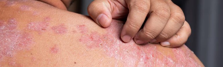 A Breakdown of Common Rashes - Charleston Dermatology