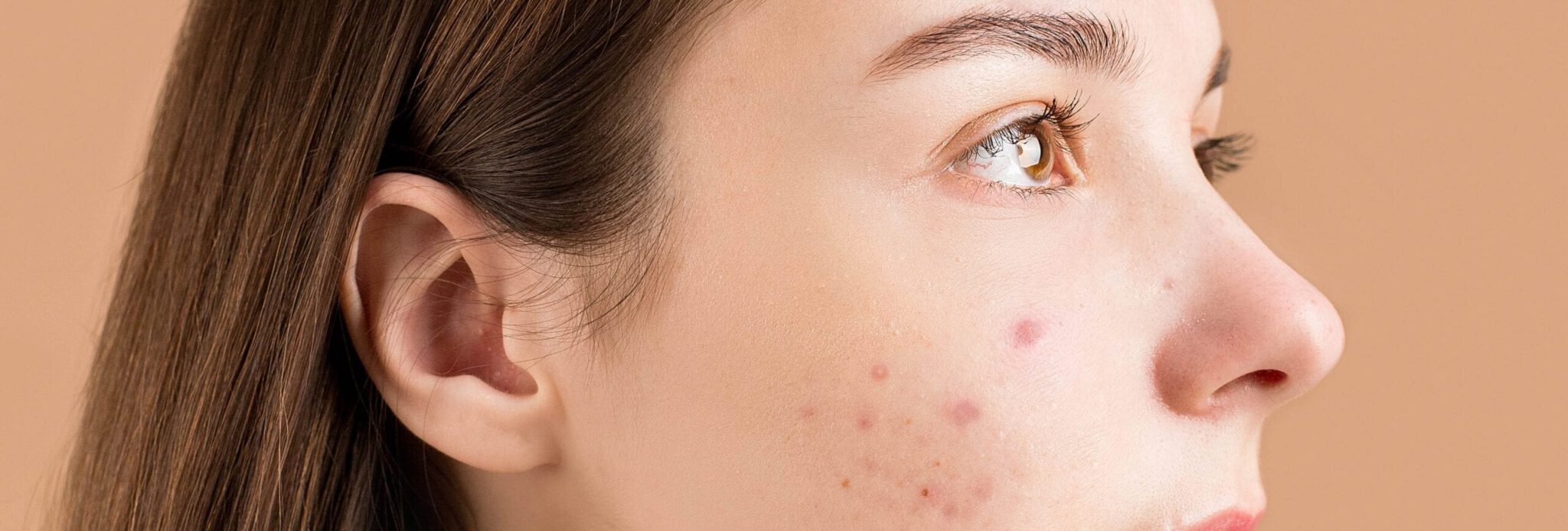 How The Sun Can Hurt and Help Your Acne - Charleston Dermatology